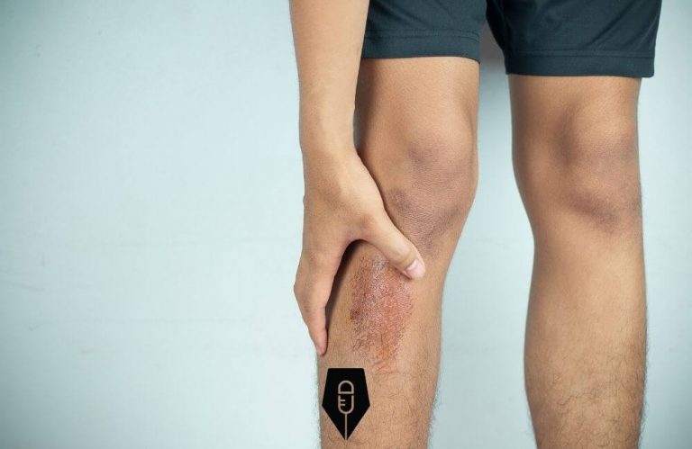 Bacaktaki Yara İzleri Nasıl Geçer? (Doğal Yöntemler)