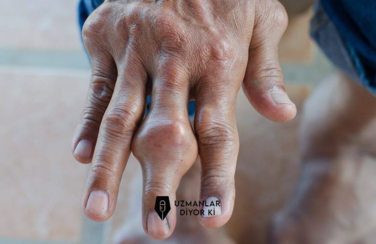 Gut Hastalığı Nedir, Belirtileri ve Tedavisi - Uzmanlar Diyor Ki